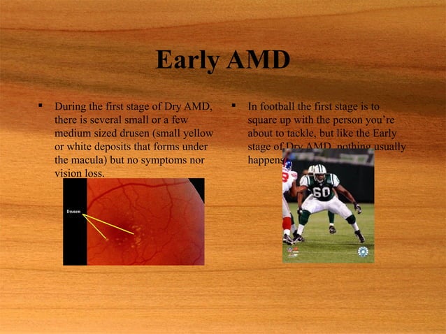 Stages of Dry AMD | PPT