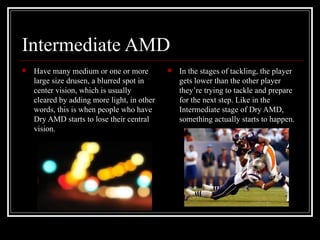 Stages of Dry AMD | PPT