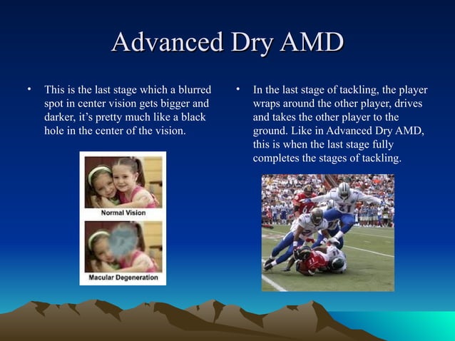 Stages of Dry AMD | PPT