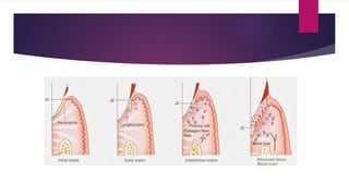 STAGES OF GINGIVAL INFLAMMATION - SALEEK AT copy.pptx