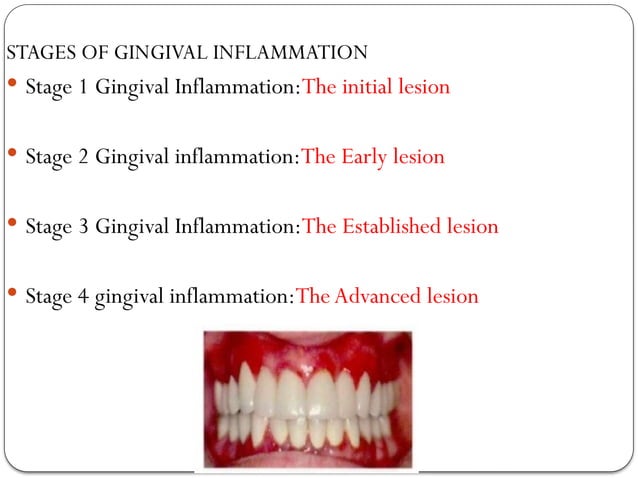 Gingival inflammation-Stages of Gingivitis.pptx | Dental Health ...