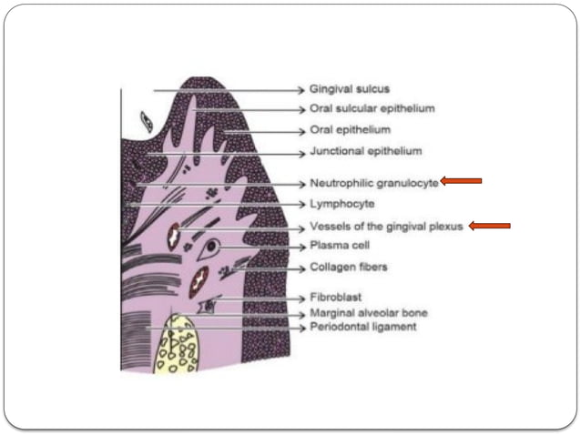 Gingival inflammation-Stages of Gingivitis.pptx | Dental Health ...
