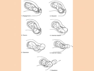Stages of Normal Labor- easy explanation | PDF
