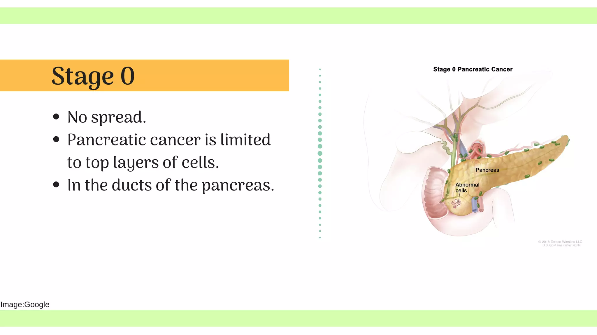 Stages of Pancreatic Cancer | PDF | Endocrine and Metabolic Diseases ...