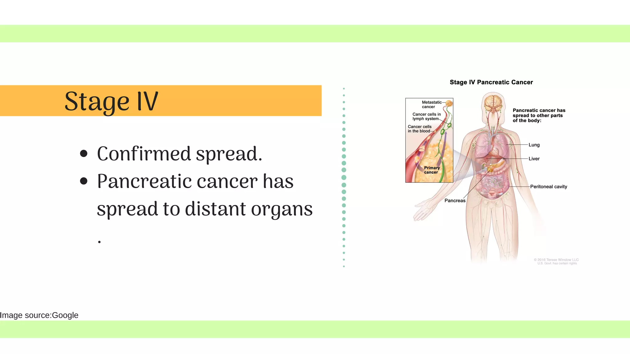 Stages of Pancreatic Cancer | PDF | Endocrine and Metabolic Diseases ...