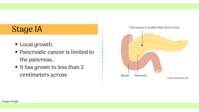 Stages of Pancreatic Cancer | PDF | Endocrine and Metabolic Diseases ...