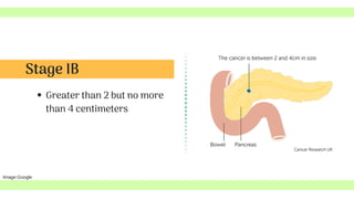 Stages of Pancreatic Cancer | PPT
