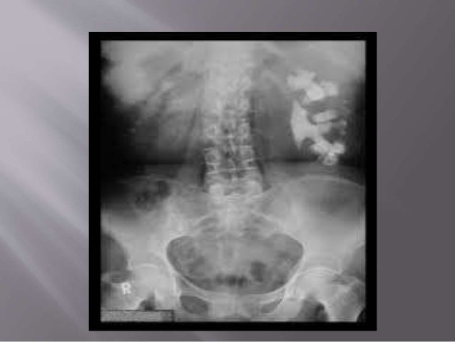 Staghorn calculi