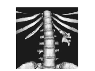 Staghorn calculus – etiology, diagnosis, management | PPTX