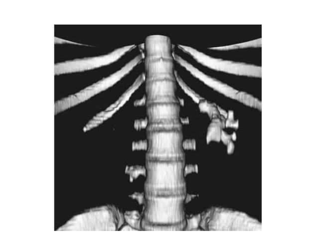 Staghorn calculus – etiology, diagnosis, management | PPTX | Chemistry ...