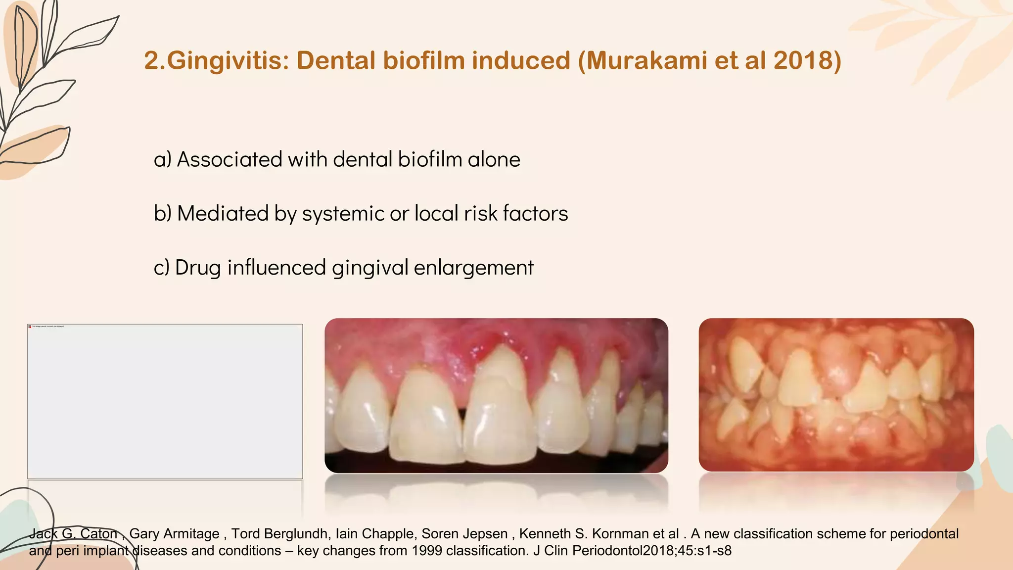STAGING AND GRADING IN PERIODONTITIS.pptx