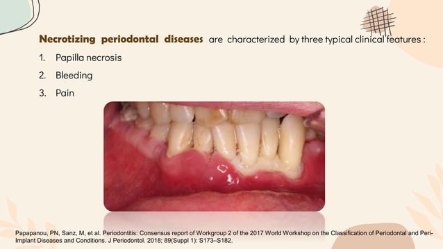 STAGING AND GRADING IN PERIODONTITIS.pptx | Dental Health | Diseases ...