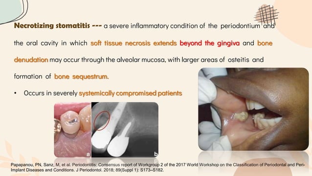 STAGING AND GRADING IN PERIODONTITIS.pptx | Dental Health | Diseases ...