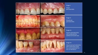 Staging and Grading of Periodontitis | PPTX