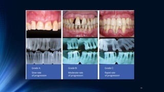Staging and Grading of Periodontitis | PPTX | Dental Health | Diseases ...