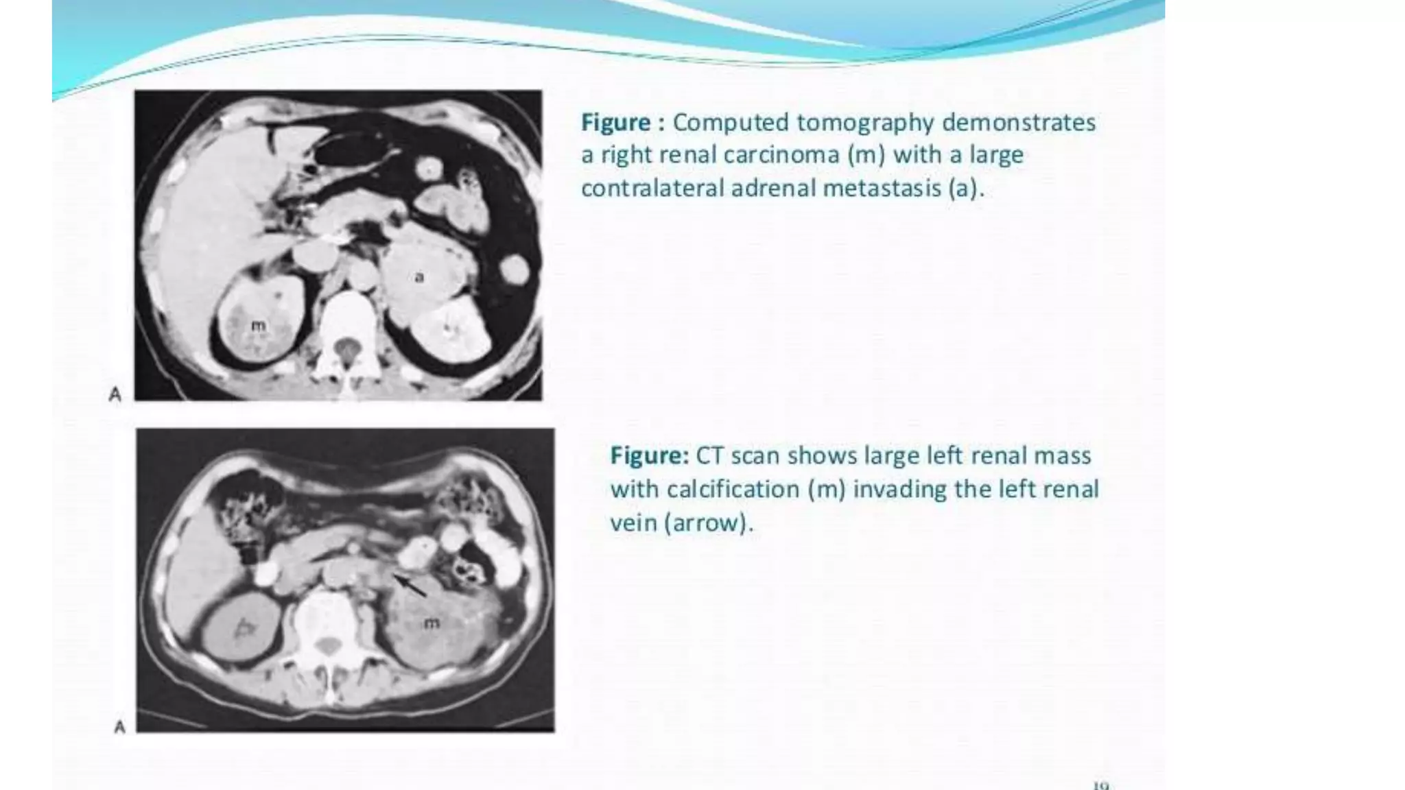 Staging and investigation of ca kidney and bladder | PPT