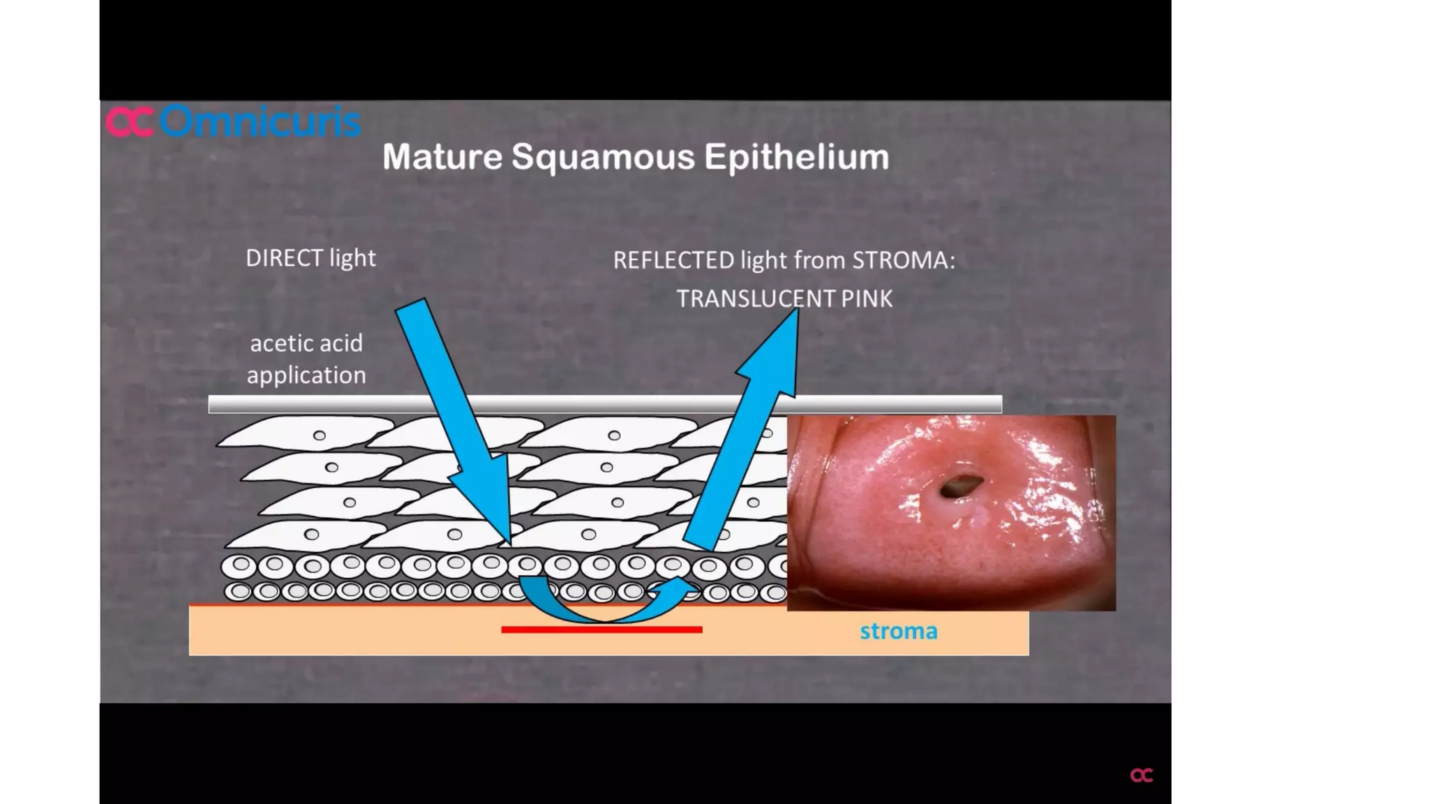 Staging and investigation of cervix and uterus | PPT