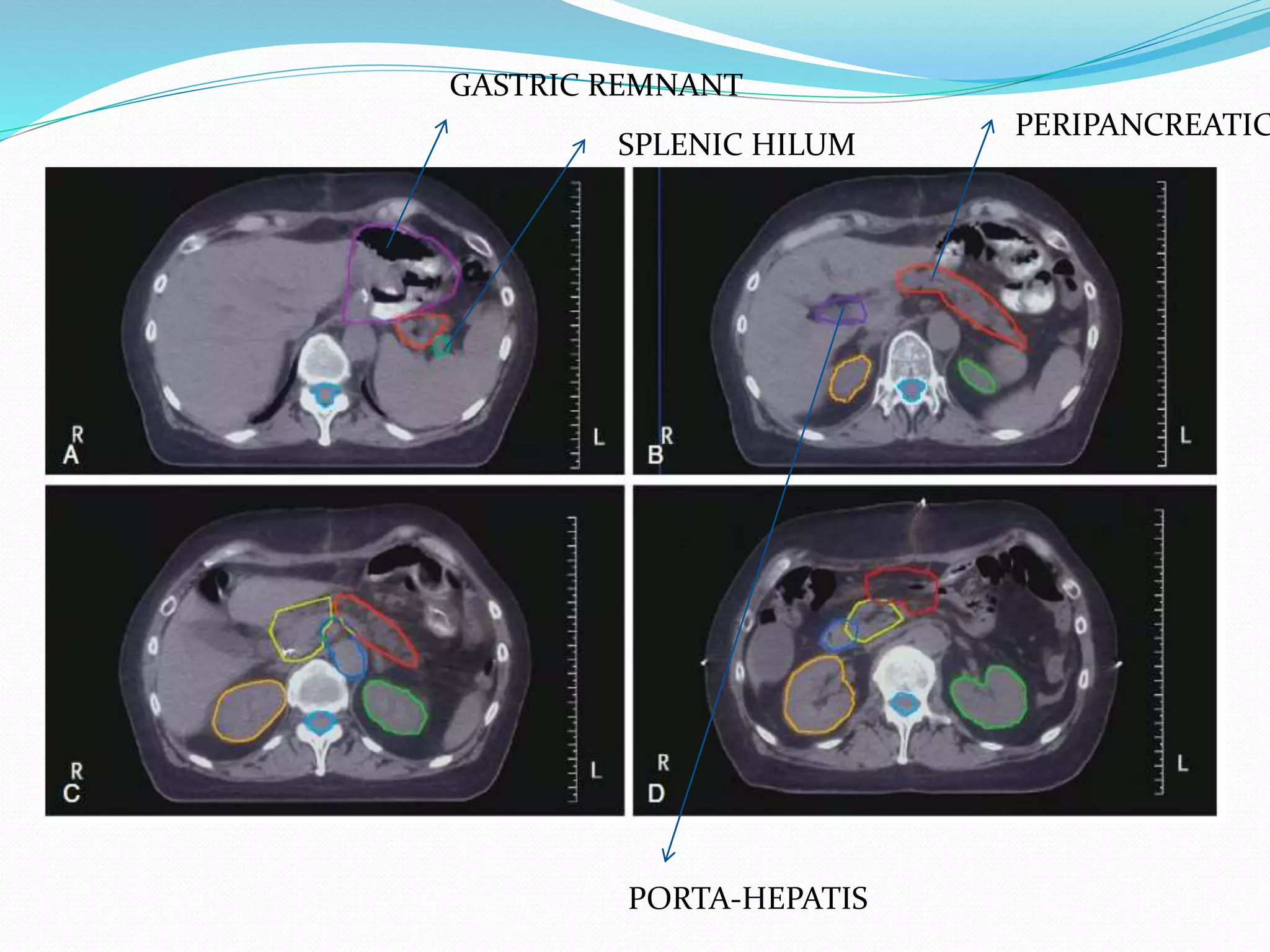 Staging and management of ca stomach | PPTX