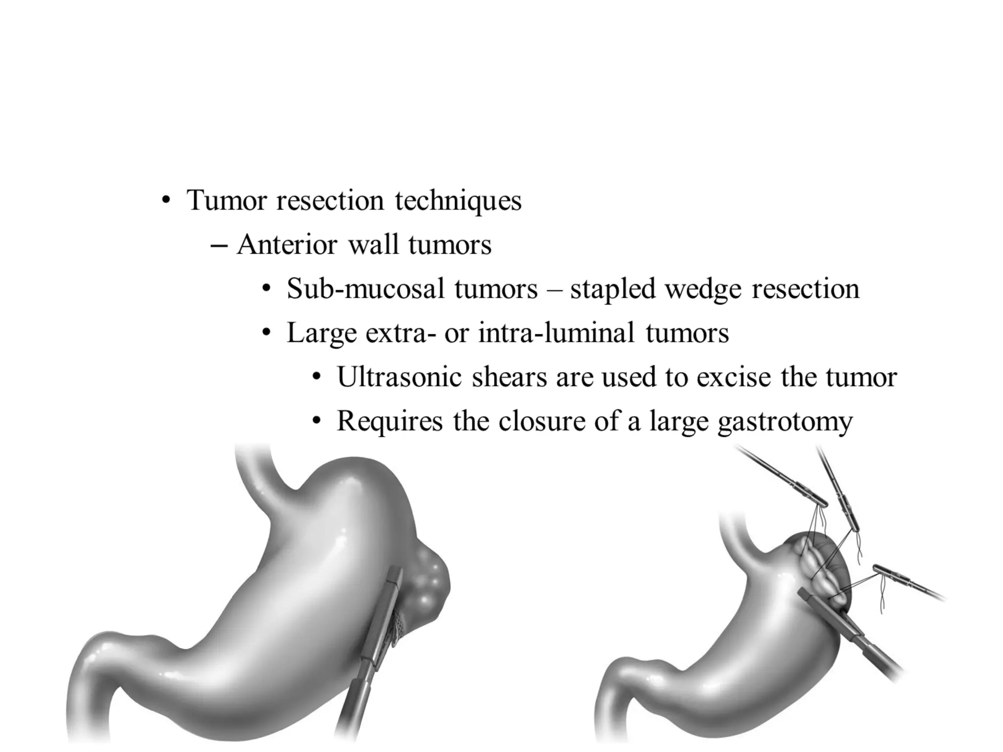 Staging and surgery of gastric carcinoma | PPT