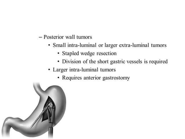 Staging and surgery of gastric carcinoma | PPT