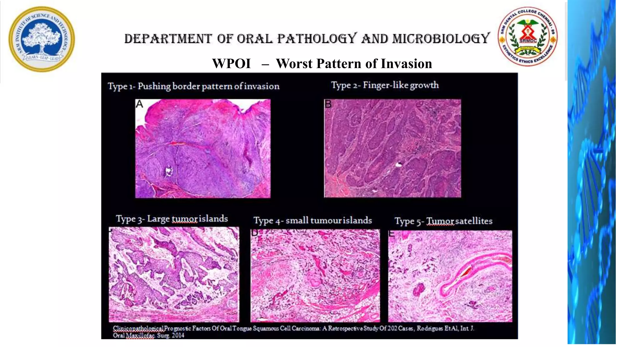 Staging & Grading of oral cancer | PPTX