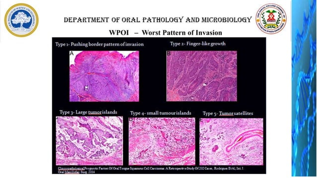 Staging & Grading of oral cancer | PPTX | Cancer | Diseases and Conditions