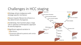 Staging in HCC.pptx