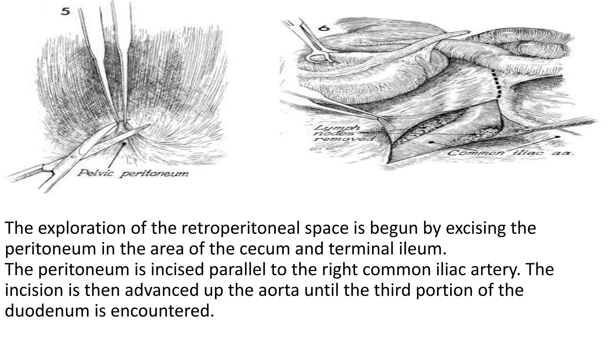 Staging laparotomy | PPTX