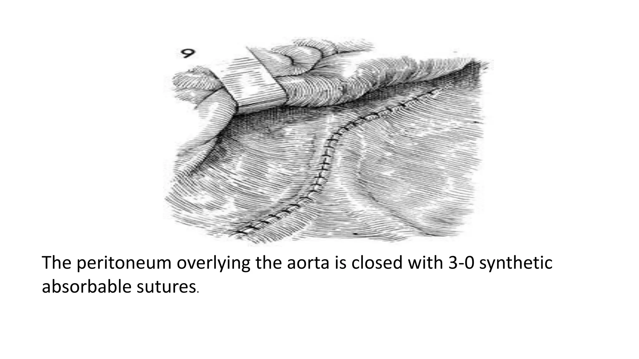 Staging laparotomy | PPTX