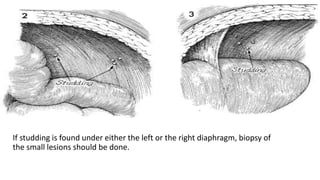 Staging laparotomy | PPTX