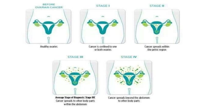 Staging laparotomy | PPTX