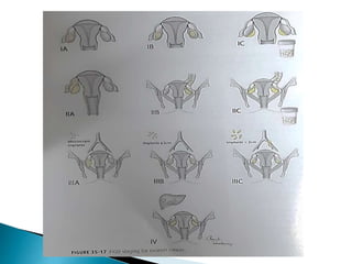 STAGING LAPAROTOMY new C123 obg ppt.pptx