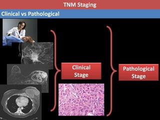 Staging of breast cancer | PPTX