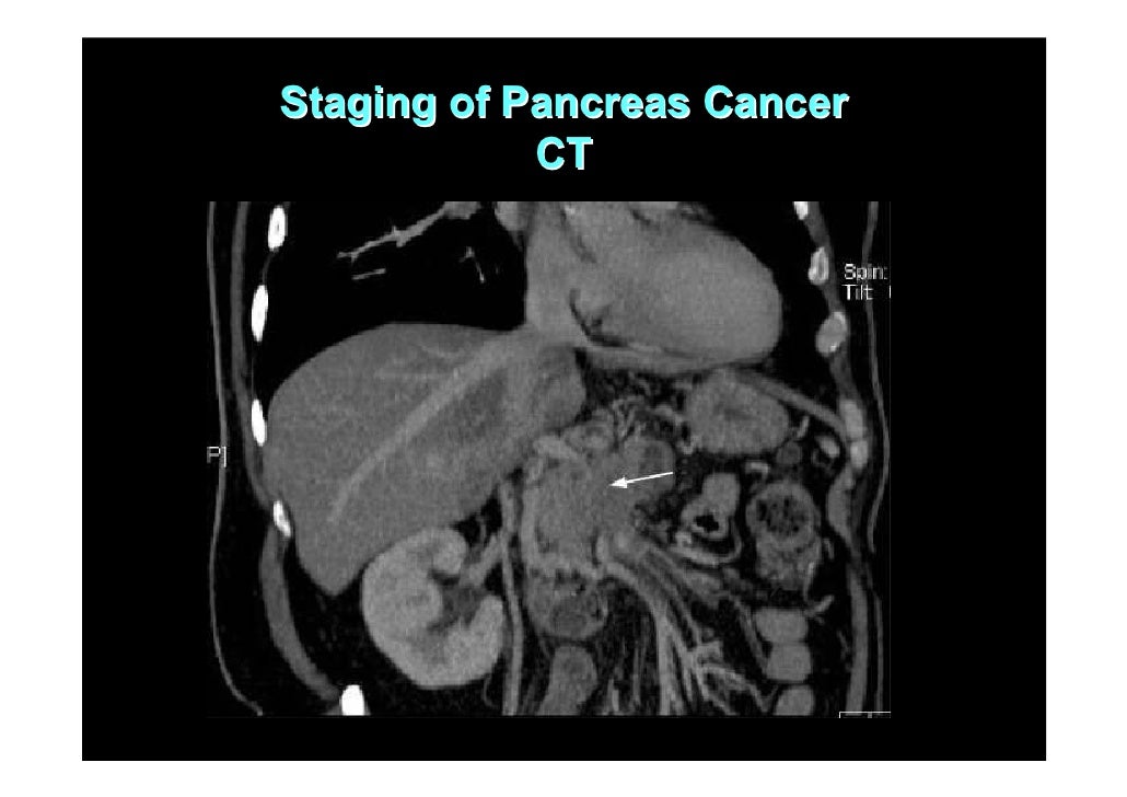 Staging and Surgical Management of Pancreatiic Cancer