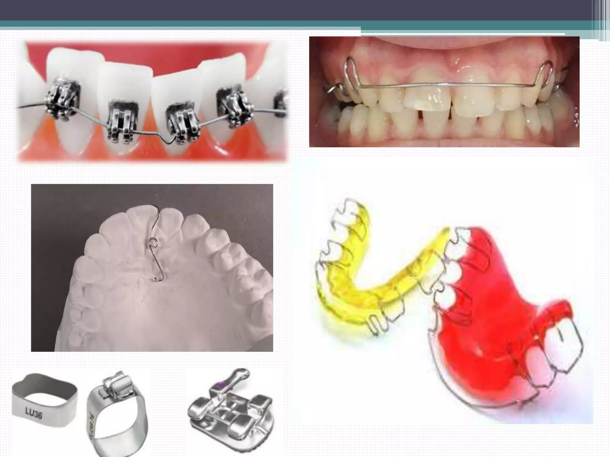 Stainless steel arch wire in orthodontics | PPTX