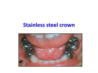 Stainless steel crown .pptx