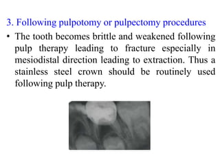 Stainless steel crown .pptx