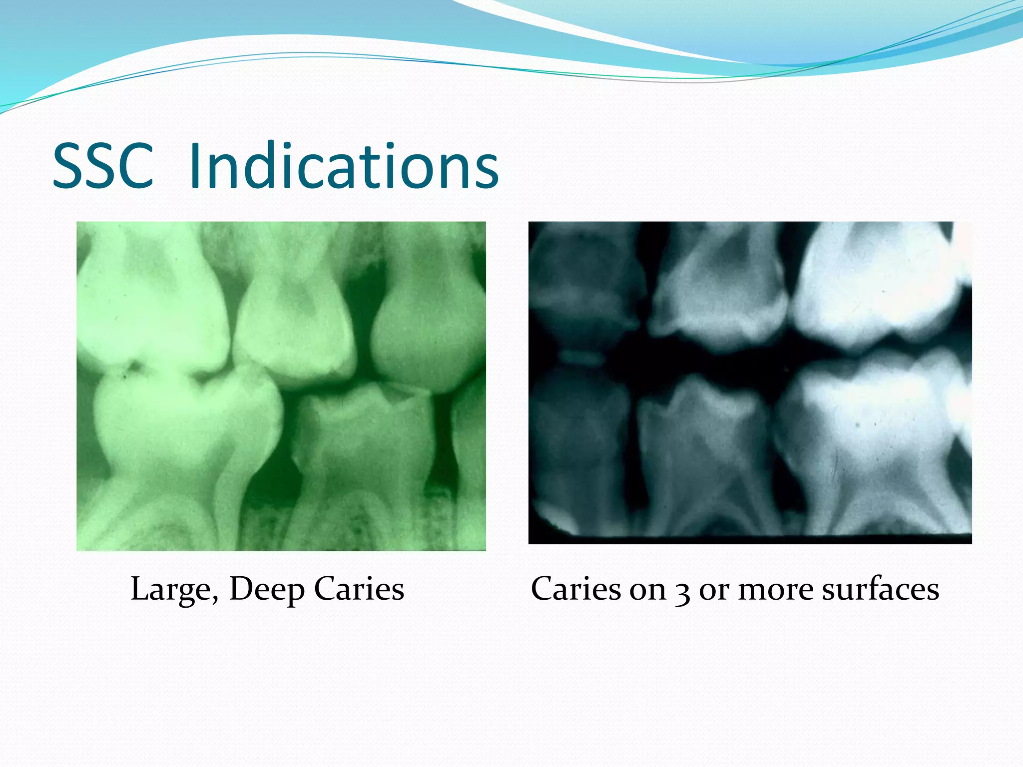 Stainless steel crowns | PPTX