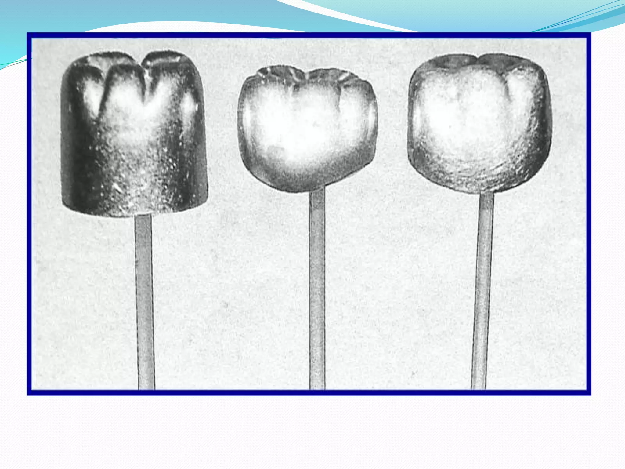 Stainless steel crowns | PPTX