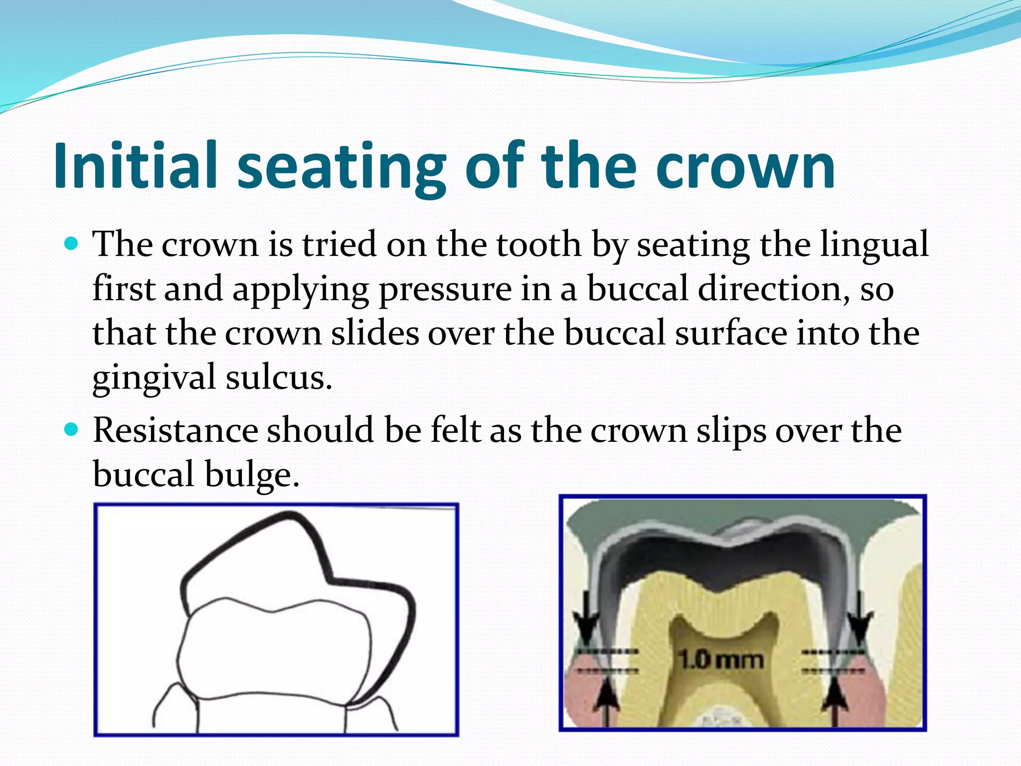 Stainless steel crowns | PPTX