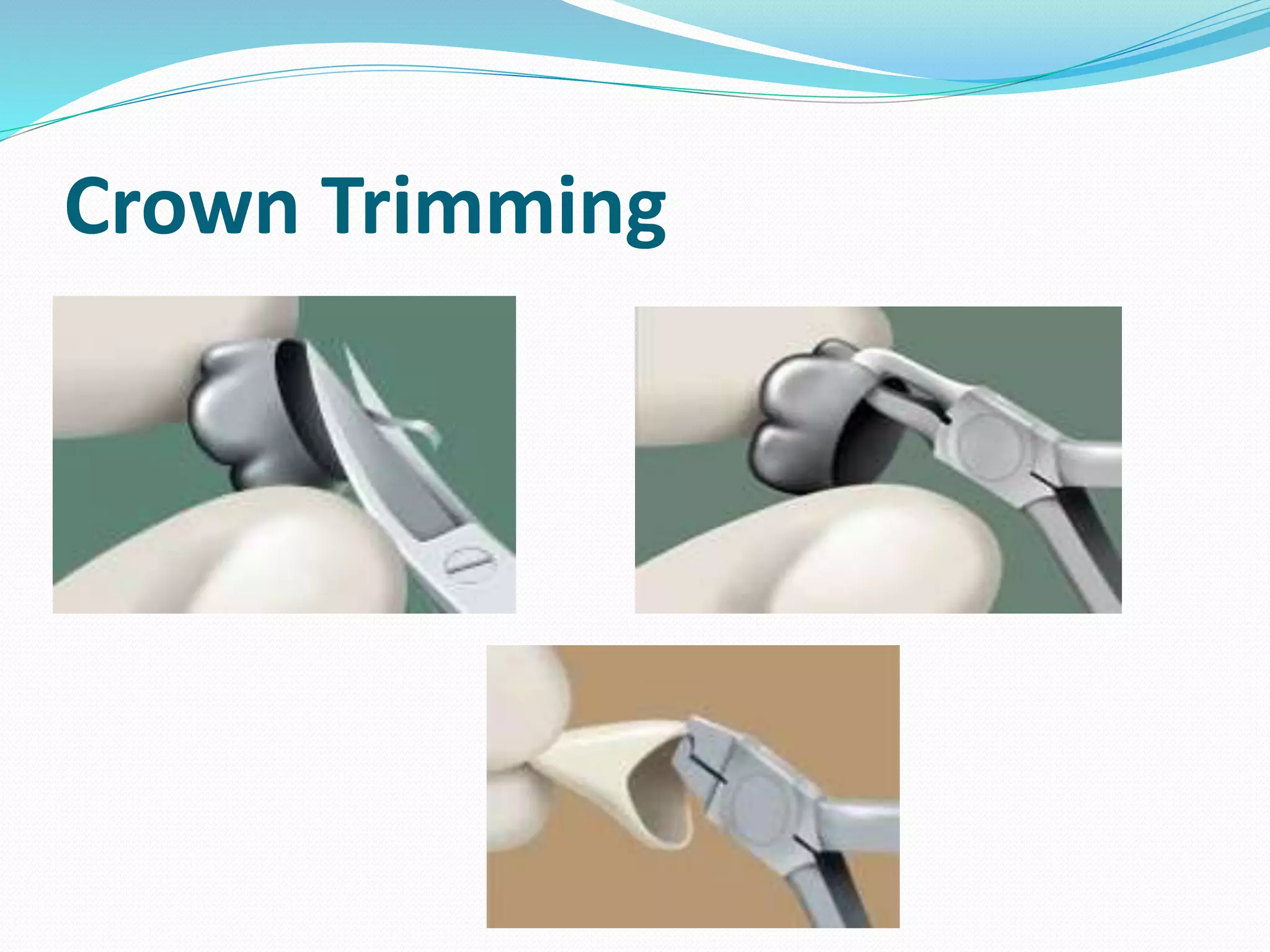 Stainless steel crowns | PPTX