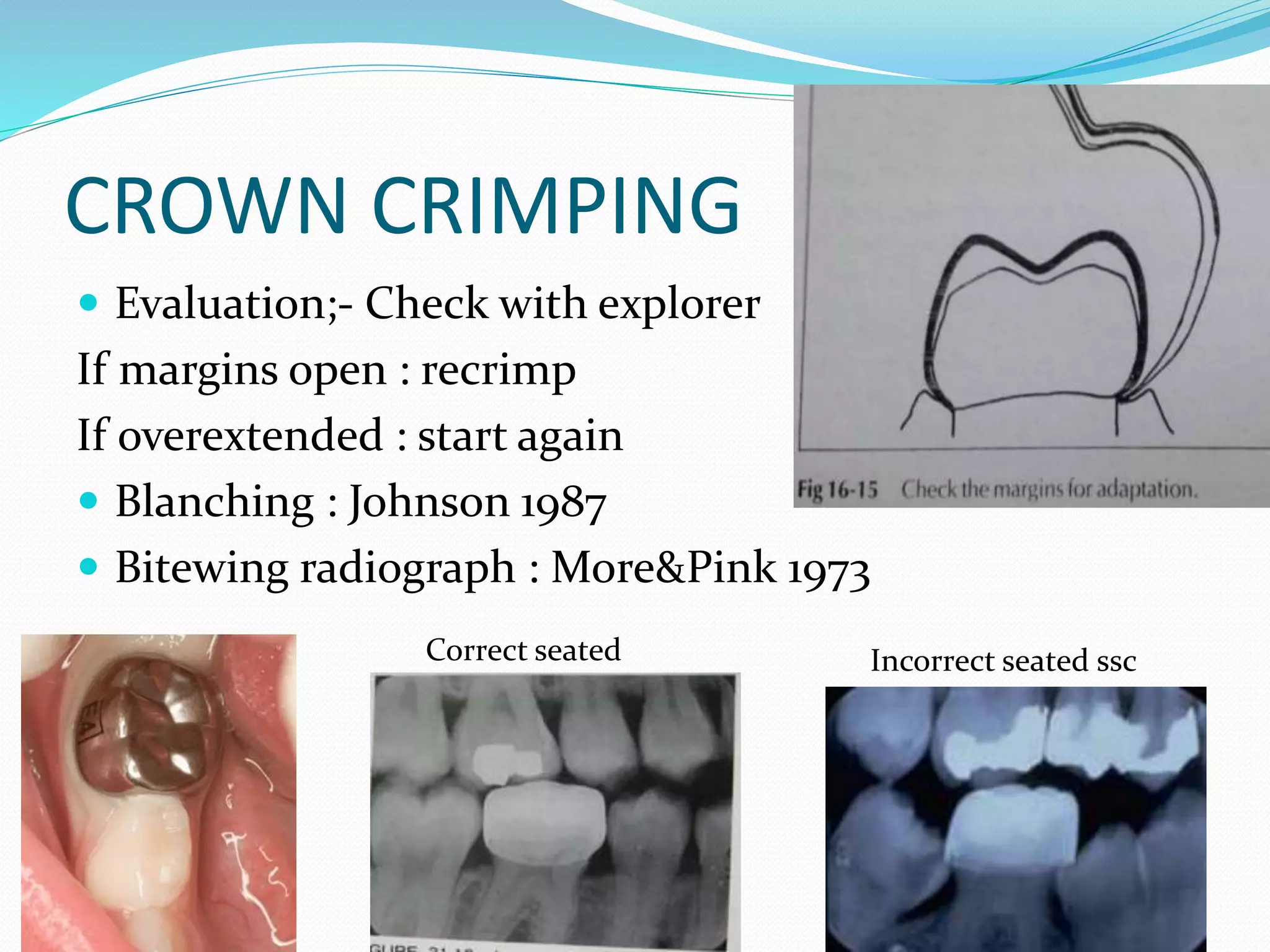 Stainless steel crowns | PPTX