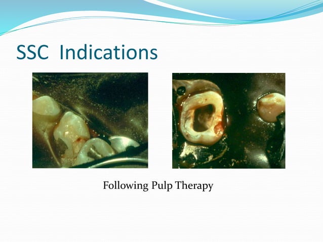 Stainless steel crowns | PPTX | Dental Health | Diseases and Conditions