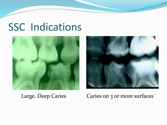 Stainless steel crowns | PPTX | Dental Health | Diseases and Conditions