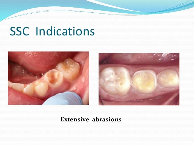 Stainless steel crowns