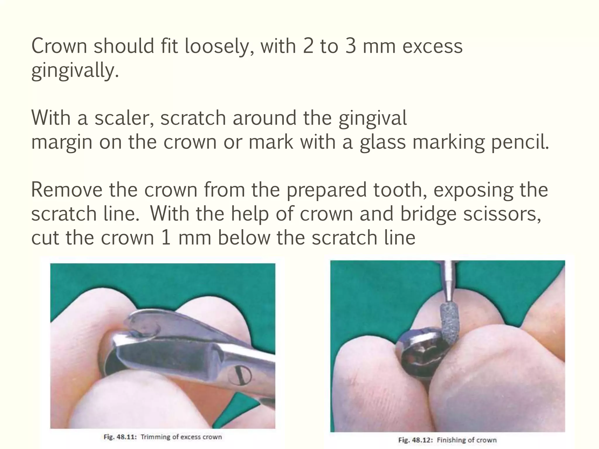 Stainless Steel Crowns | PPTX
