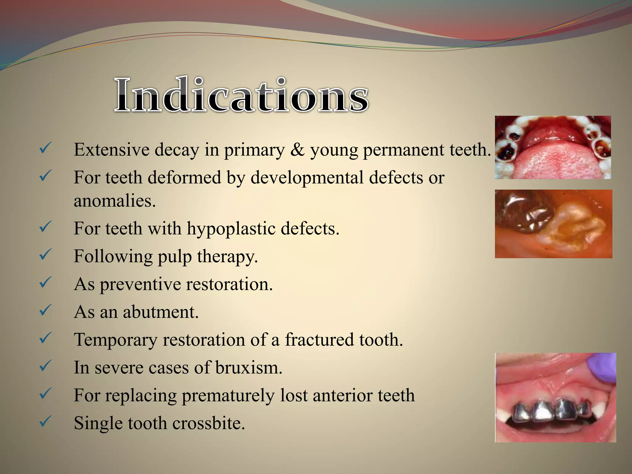 Stainless steel crowns | PPTX
