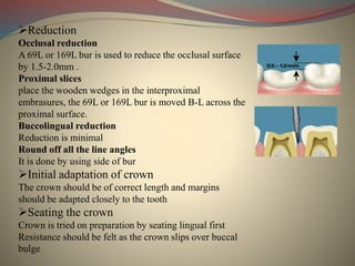 Stainless steel crowns | PPT