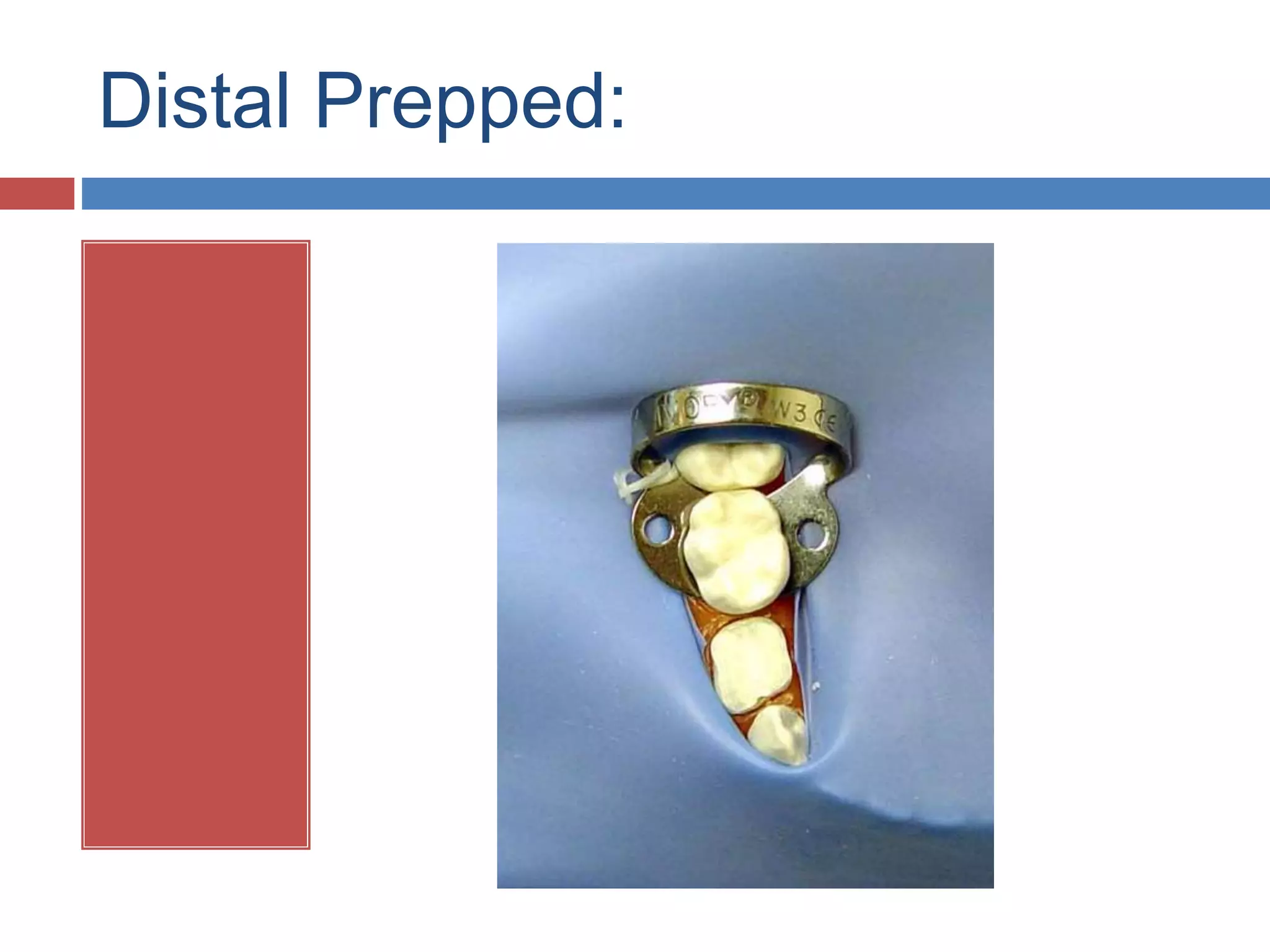 Stainless steel crowns for primary teeth | PPT