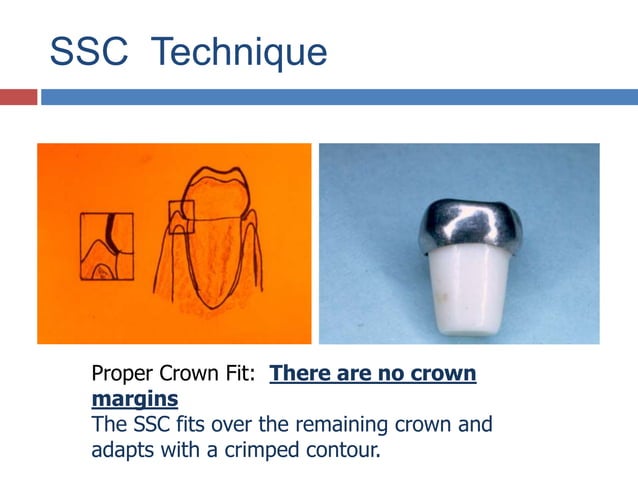 Stainless steel crowns for primary teeth | PPT
